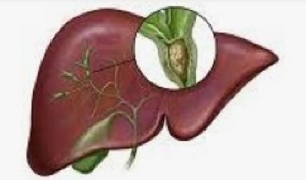 PEMAZYRE佩米替尼/培米加替尼使用剂量说明，培米加替尼是否有仿制药上市？_海得康海外新特药